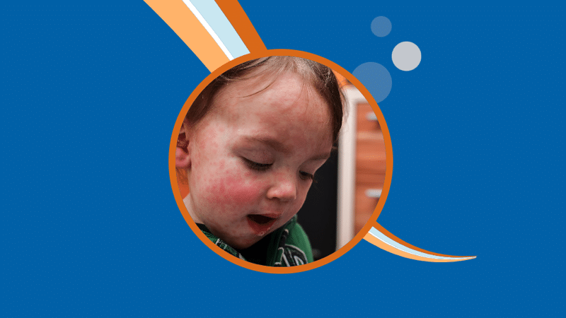 Bof, mazelen, rodehond, kinkhoest bij kinderen - DOC-learning